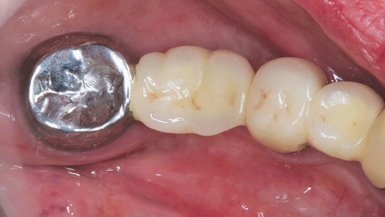 BruxZir Full-Strength Zirconia - Glidewell Dental México