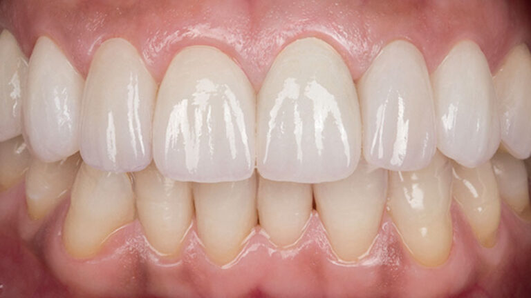 BruxZir Esthetic Zirconia - Glidewell Dental México