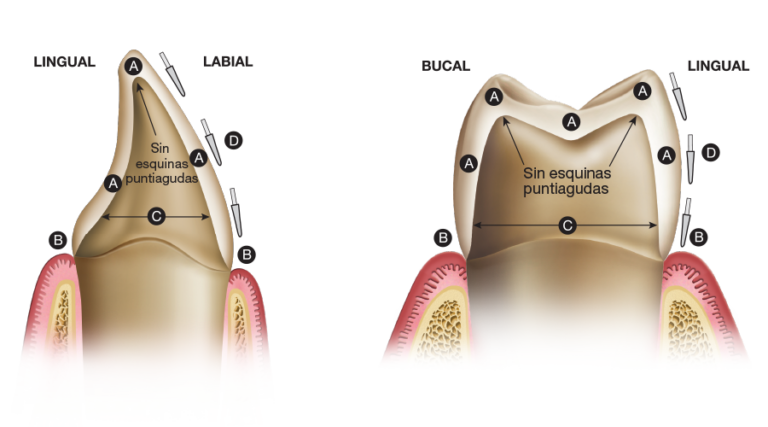 BruxZir Esthetic Zirconia - Glidewell Dental México